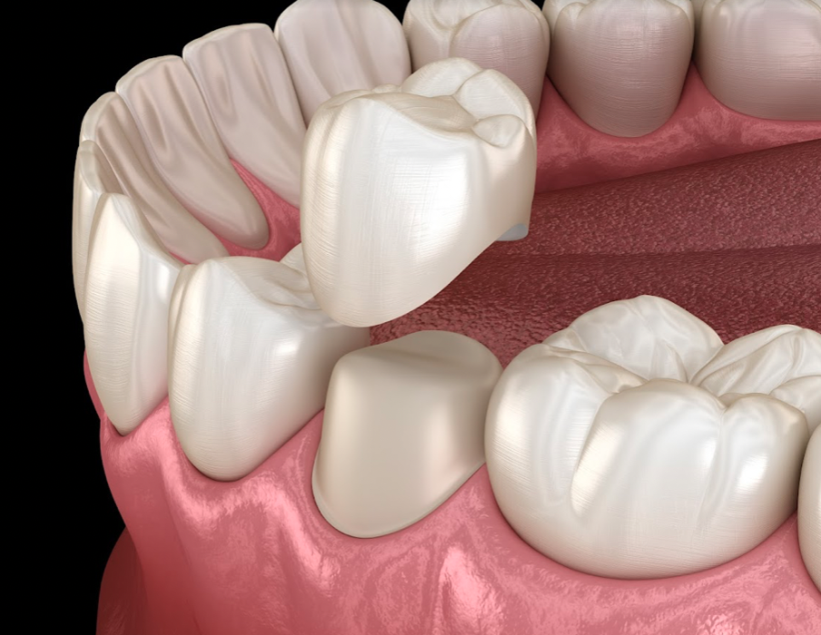 Dental Crowns Lincoln, NE | Tooth Crowns & Bridges