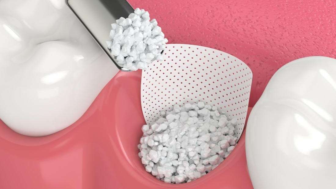 What if I Don't Have Enough Bone for Implants? | Dental Implants Lincoln